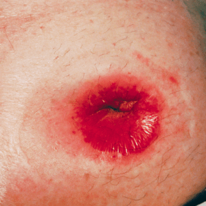 Stoma Prolapse, Stenosis, and Retraction - Ostomy Canada Society